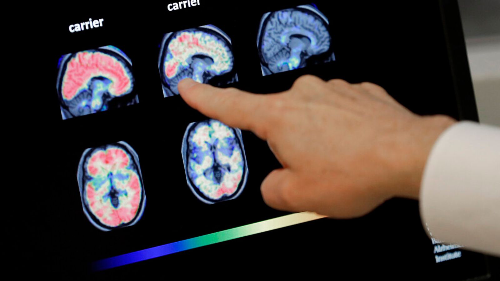 Mjekët zbulojnë ilaçin e Alzheimer që ngadalëson rënien e kujtesës ... Mjekët zbulojnë ilaçin e Alzheimer që ngadalëson rënien e kujtesës ...
